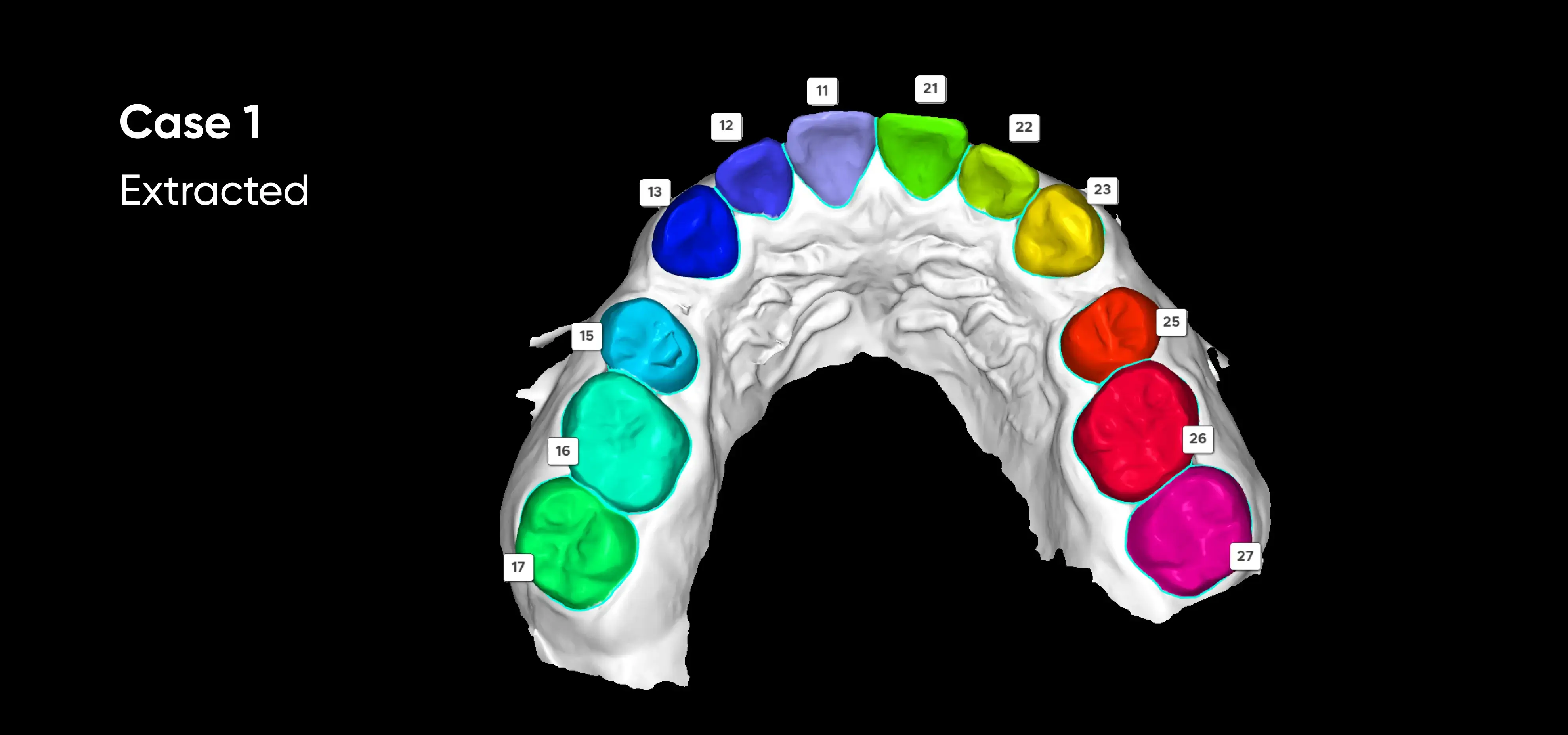 Case 1 Upper Teeth Scan With Every Tooth In Different Color And Number